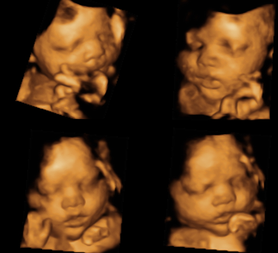 33 weeks - Take 2 4D scan share.