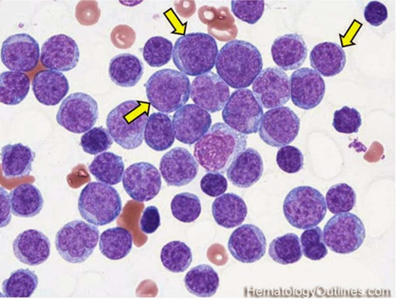 Biomedicina em Foco: Leucocitose com presença de blastos