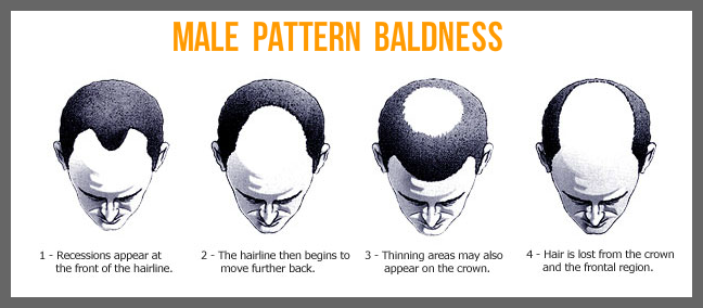 Male Pattern Baldness Treatment