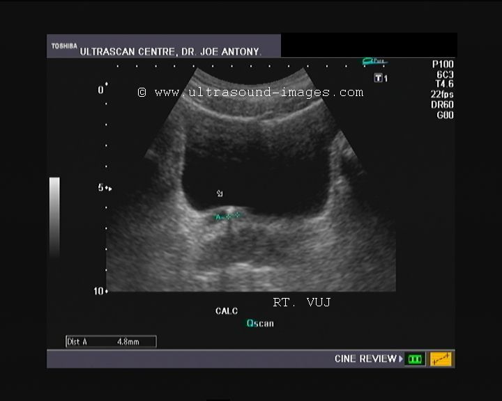 cochinblogs: Kidney stones- renal calculi- urinary stones