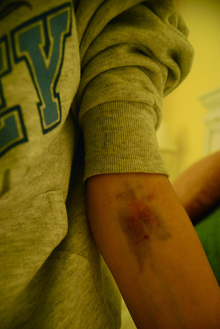 Deformutilation: Needle Bruises