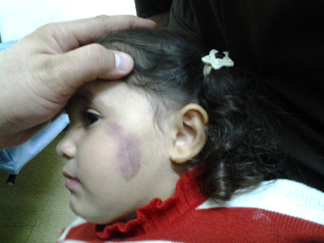 VIRTUAL GRAND ROUNDS IN DERMATOLOGY 2.0: Facial Lesion in a Child