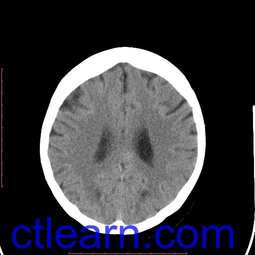 Diagnosis of a CT scan on the brain, with the report -2