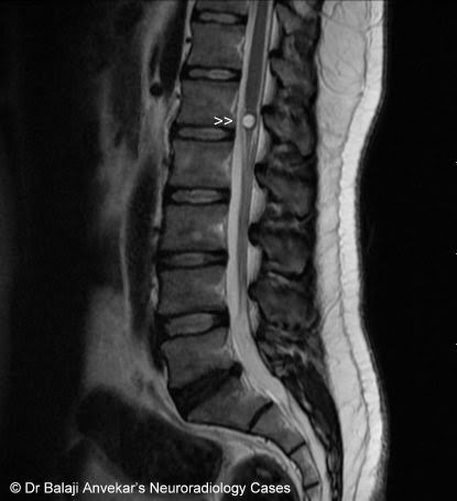 Dr Balaji Anvekar FRCR: Ventriculus Terminalis of the Conus Medullaris