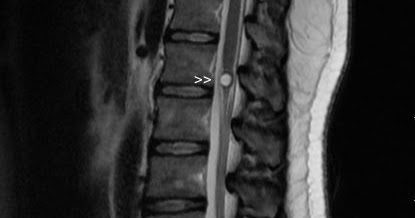Dr Balaji Anvekar FRCR: Ventriculus Terminalis of the Conus Medullaris