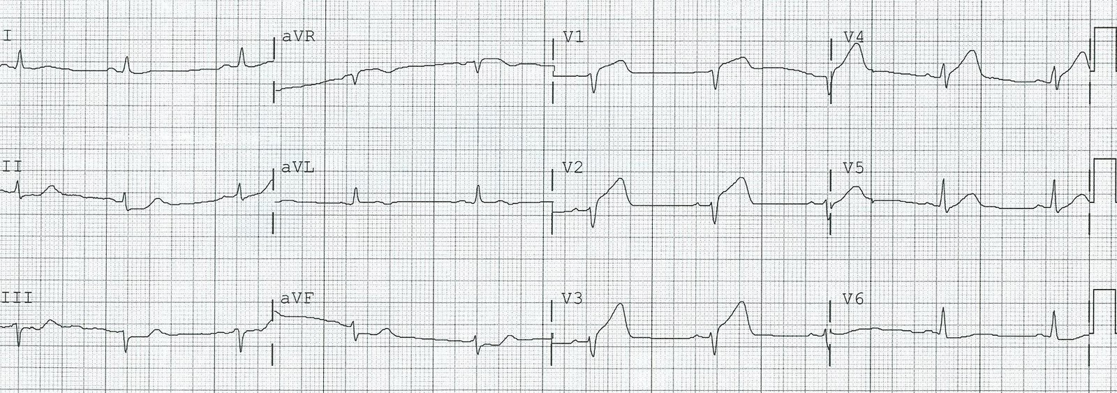 Dr. Smith's ECG Blog: Serial ECGs confirm initial suspicion of anterior ...