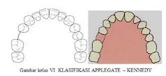 Klasifikasi Applegate-Kennedy | SERBA SERBI DENTISTRY