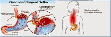 MENGENAL SAKIT LAMBUNG YANG TAK KUNJUNG SEMBUH / GERD