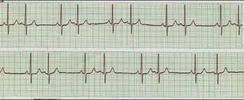 Living With AVNRT: So here's my question...what IS AVNRT???