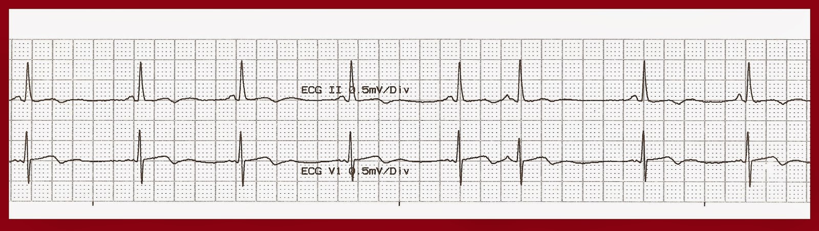 EKG Rhythm Quiz 281