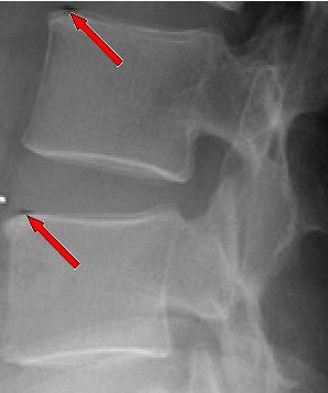 ABC Radiology Blog: Knutsson's Sign