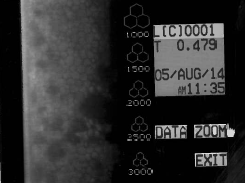 Miranza IOA: CÓRNEA GUTTATA. DISTROFIA ENDOTELIAL DE FUCHS