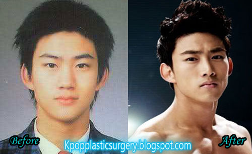 Taecyeon Teeth Surgery