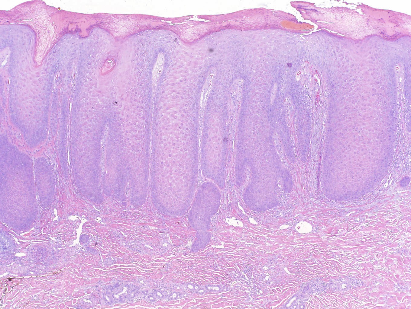 VIRTUAL GRAND ROUNDS IN DERMATOLOGY 2.0: Prurigo Nodularis with ...