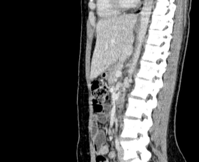Ultimate Radiology : Pseudolesion : Papillary Process of Caudate Lobe