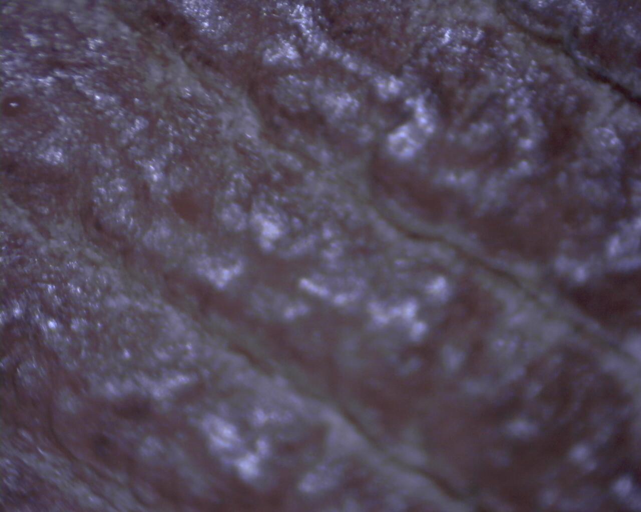 Bomani Research: Foot Callus