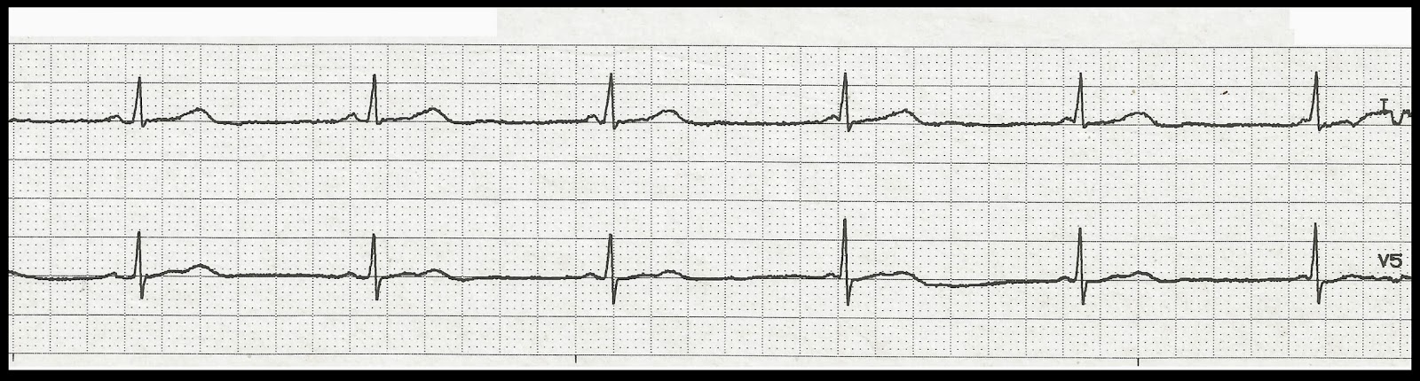 Practice EKG Rhythm Strips 222