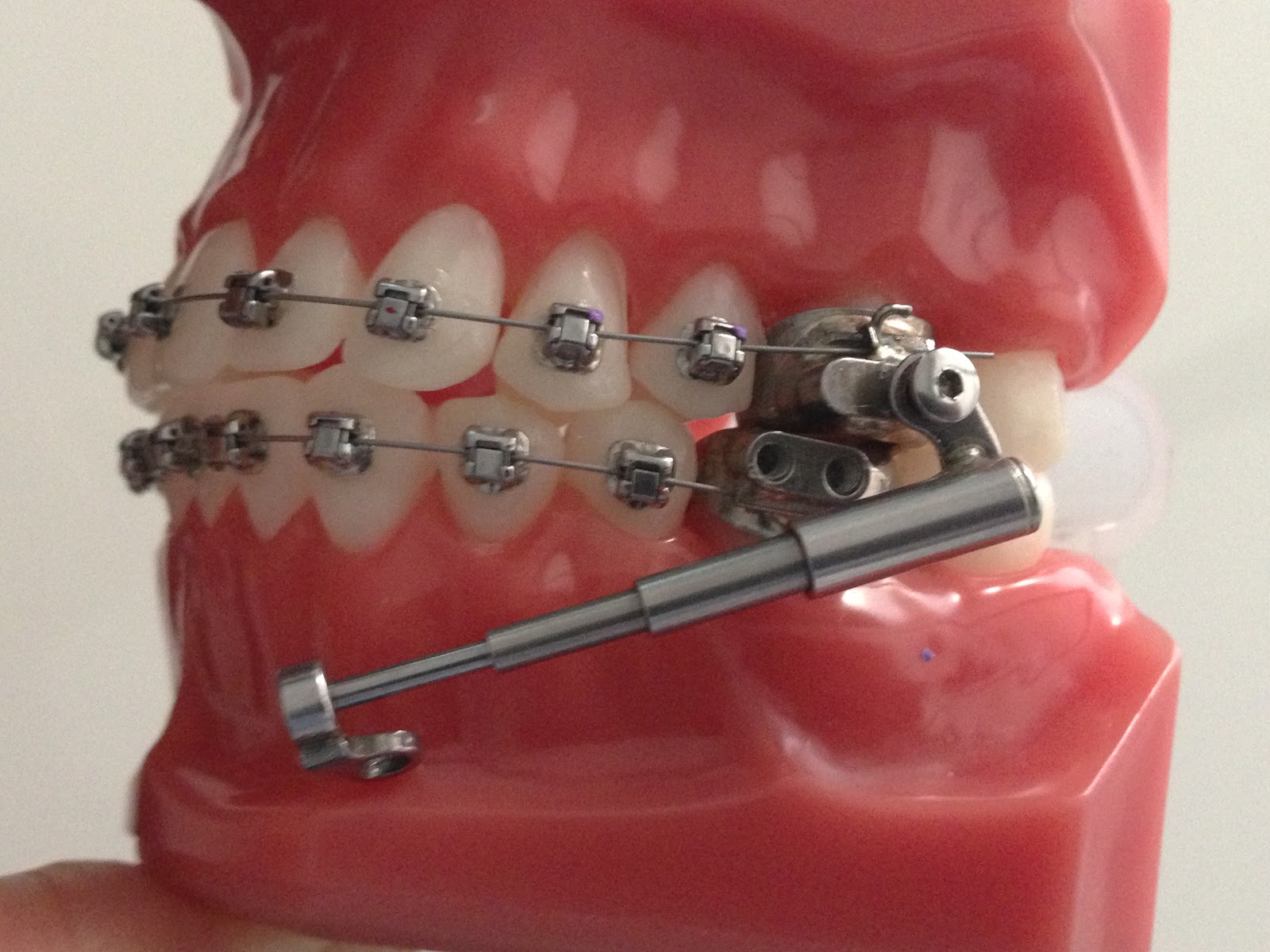 ORTODONCIA INVISIBLE HABIB BARHOUM: ADVANSYNC 2 - ORMCO