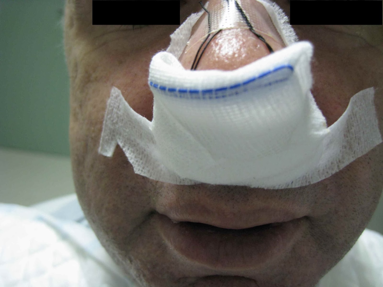 El OtoBlog: Epistaxis (III): La "bigotera" y las recomendaciones
