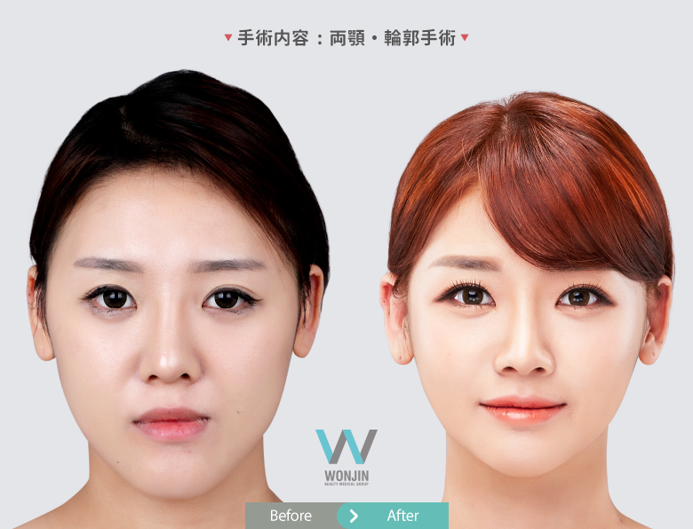 Perbedaan antara operasi dua rahang dan rahang? Operasi apa yang cocok ...