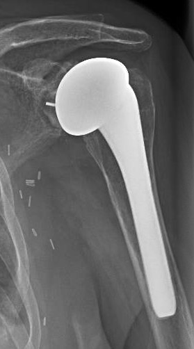 Shoulder Arthritis / Joint Replacement : Locked dislocation of a total ...