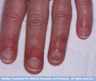 Exordios Clínicos: Diagnóstico: Caso No. 9