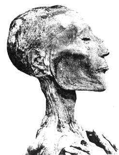 Minimum Vita: Microbiologia Histórica: A VARÍOLA