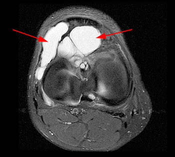 Radiology Pearls: Infrapatellar (Hoffa's fat pad) ganglion cyst