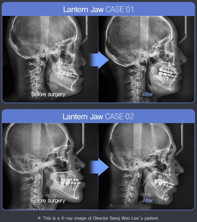 5 Case of Double Jaw Surgery Solution