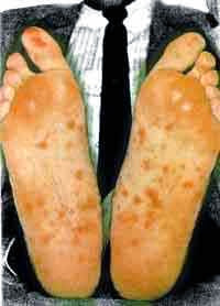 TABIBU WA KWELI: FAHAMU KISONONO DALILI,VIPIMO VYA KITABIBU NA TIBA YAKE..