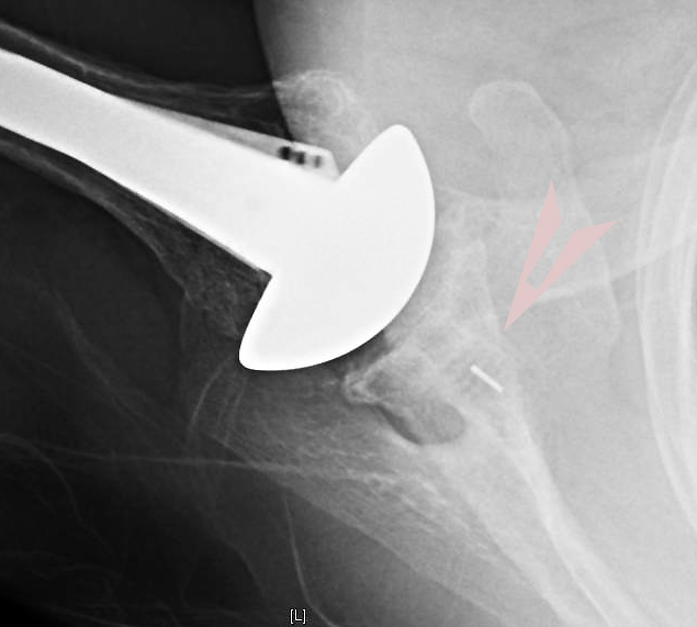 Shoulder Arthritis / Rotator Cuff Tears / Shoulder Pain : Stemless ...