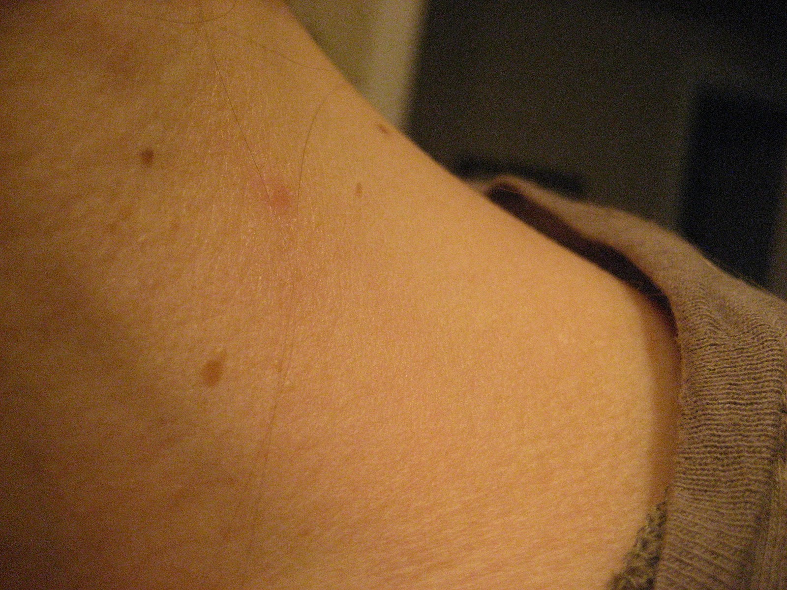 Chemical Peels for Acne and Anti Aging: Remove Skin Tags with TCA Peels ...