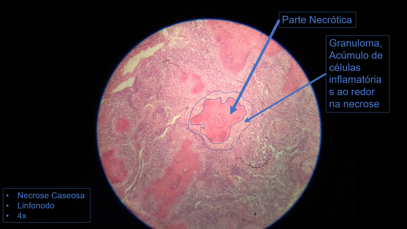 Patologia em atlas: Tipos de Necrose