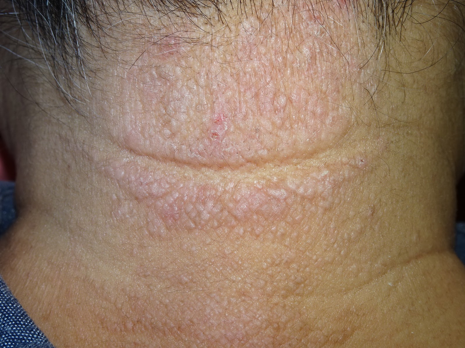 Consultations in Dermatology