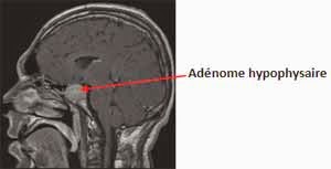 Adénomes; adenome; adenome basocellulaire; adenome folliculaire ...