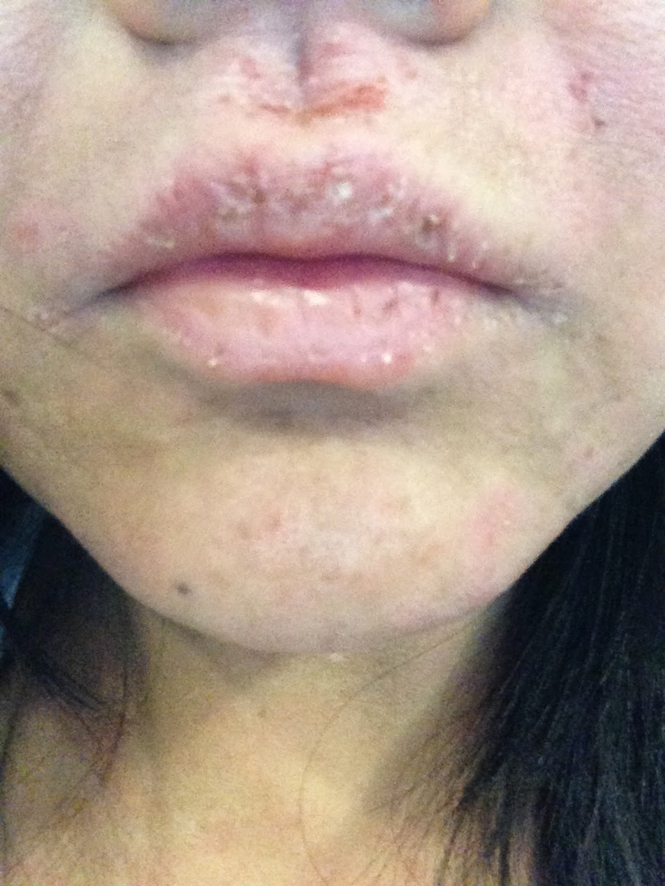 My journey to healthy skin: VIRAL: My skin caught a cold, then gave it ...