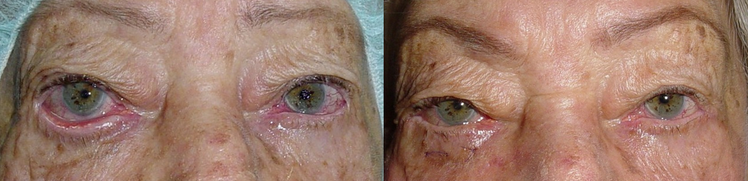 CORRECCION DEL ECTROPION