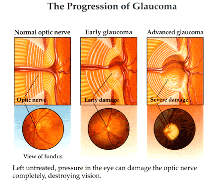 Eye Disease Glaucoma- Symptoms, Management, Treatment and Prevention ...