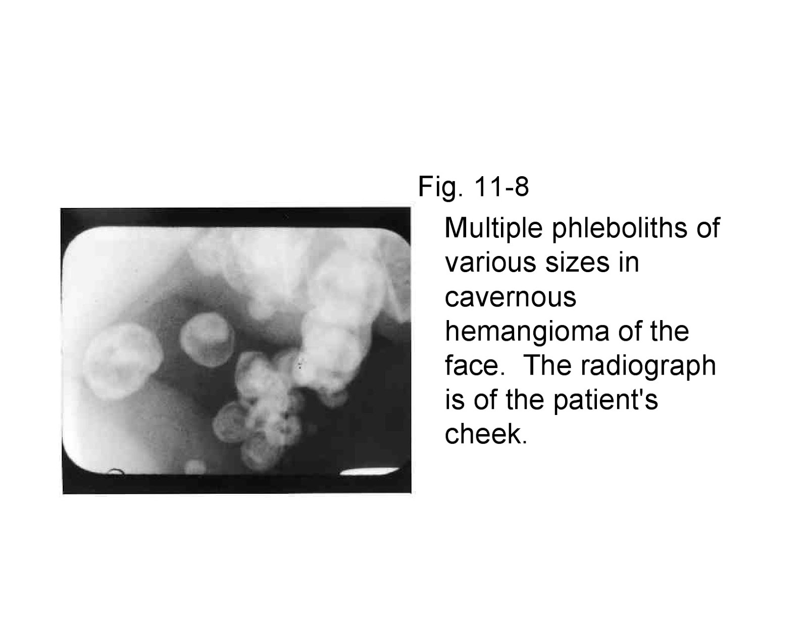 Dentistry and Medicine: SOFT TISSUE CALCIFICATIONS IN ORO-MAXILLO ...
