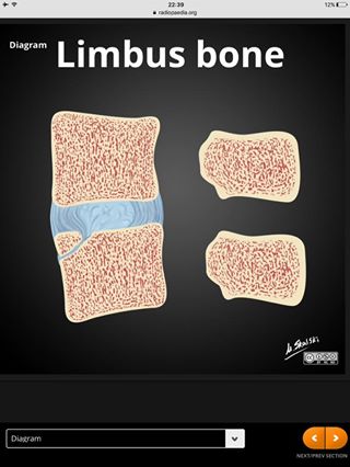 Limbus vertebrae | CĐHA | CHẨN ĐOÁN HÌNH ẢNH