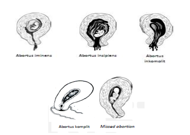 Abortus ~ Panduan Praktik Klinis Bagi Dokter