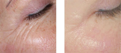 Medical laser beauty