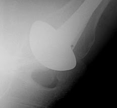 Shoulder Arthritis/Joint Replacement Rotator cuff tears: The ream and ...