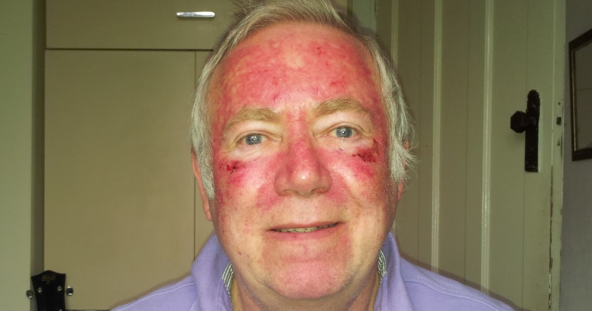 Alan's Efudix/Efudex Experience