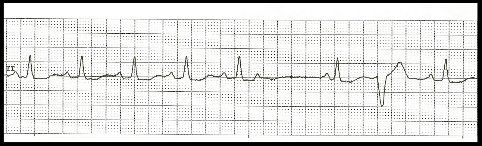 Practice EKG Rhythm Strips 163