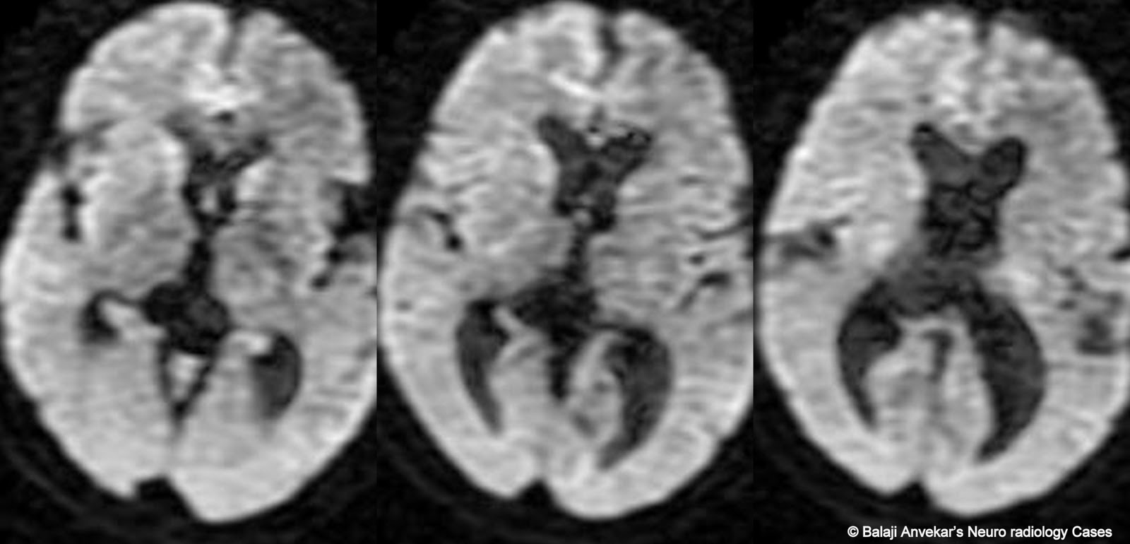 Dr Balaji Anvekar FRCR: Ependymal cyst MRI