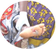 ChildCare and Jigger Eradication Programme: About Jiggers