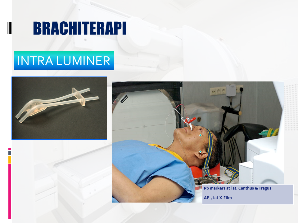 Definisi Radioterapi, Radiasi, Alat-Alat Radio Terapi, Pesawat ...