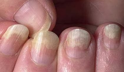 HAGO NAILS: ONYCHOLIZA czyli oddzielanie się płytki paznokciowej
