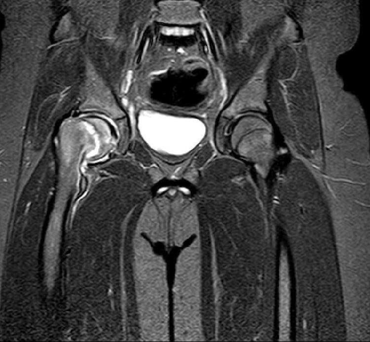 Slipped Upper Femoral Epiphysis-MRI - Sumer's Radiology Blog
